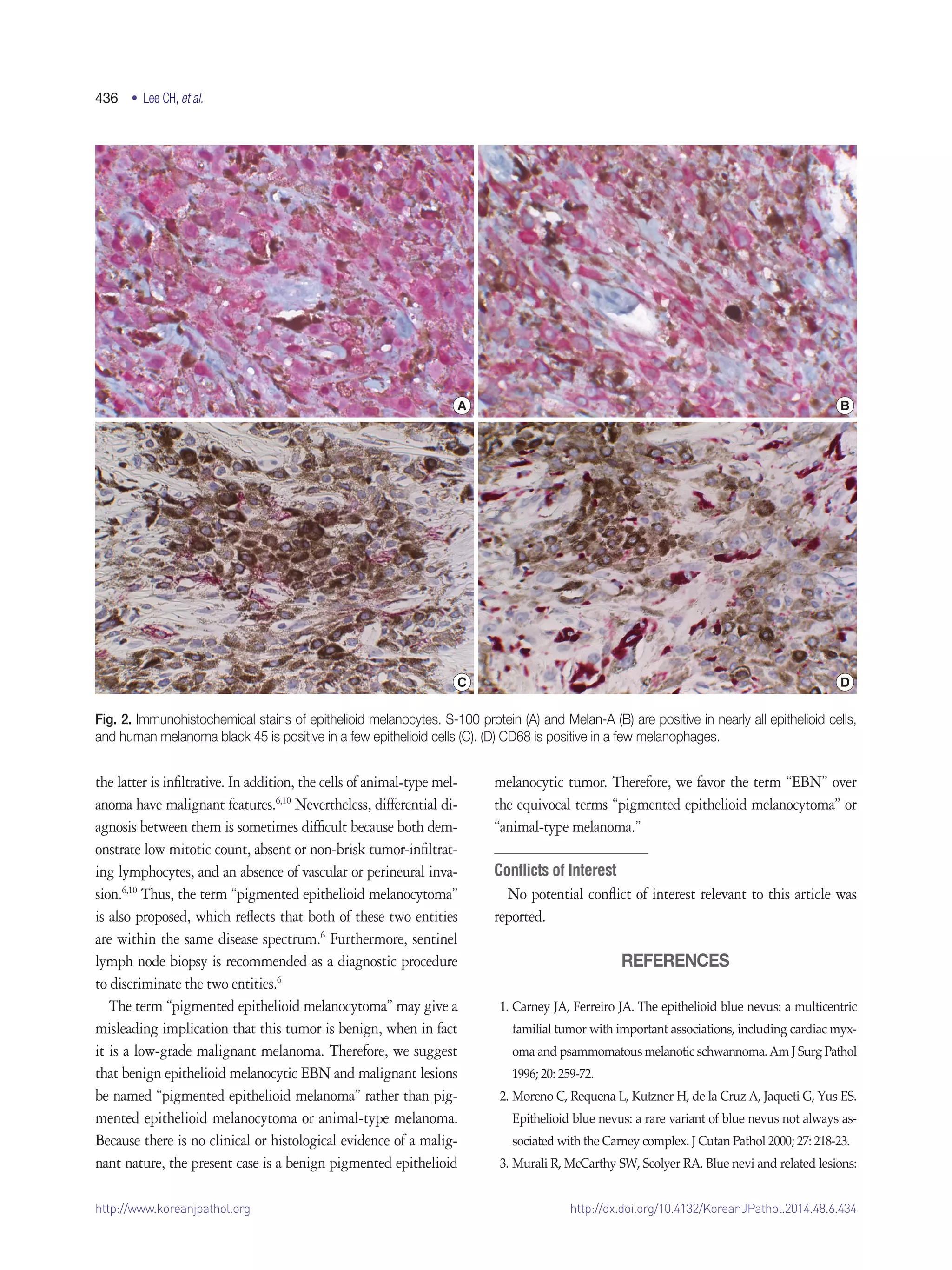 A case of epithelioid blue nevus | PDF
