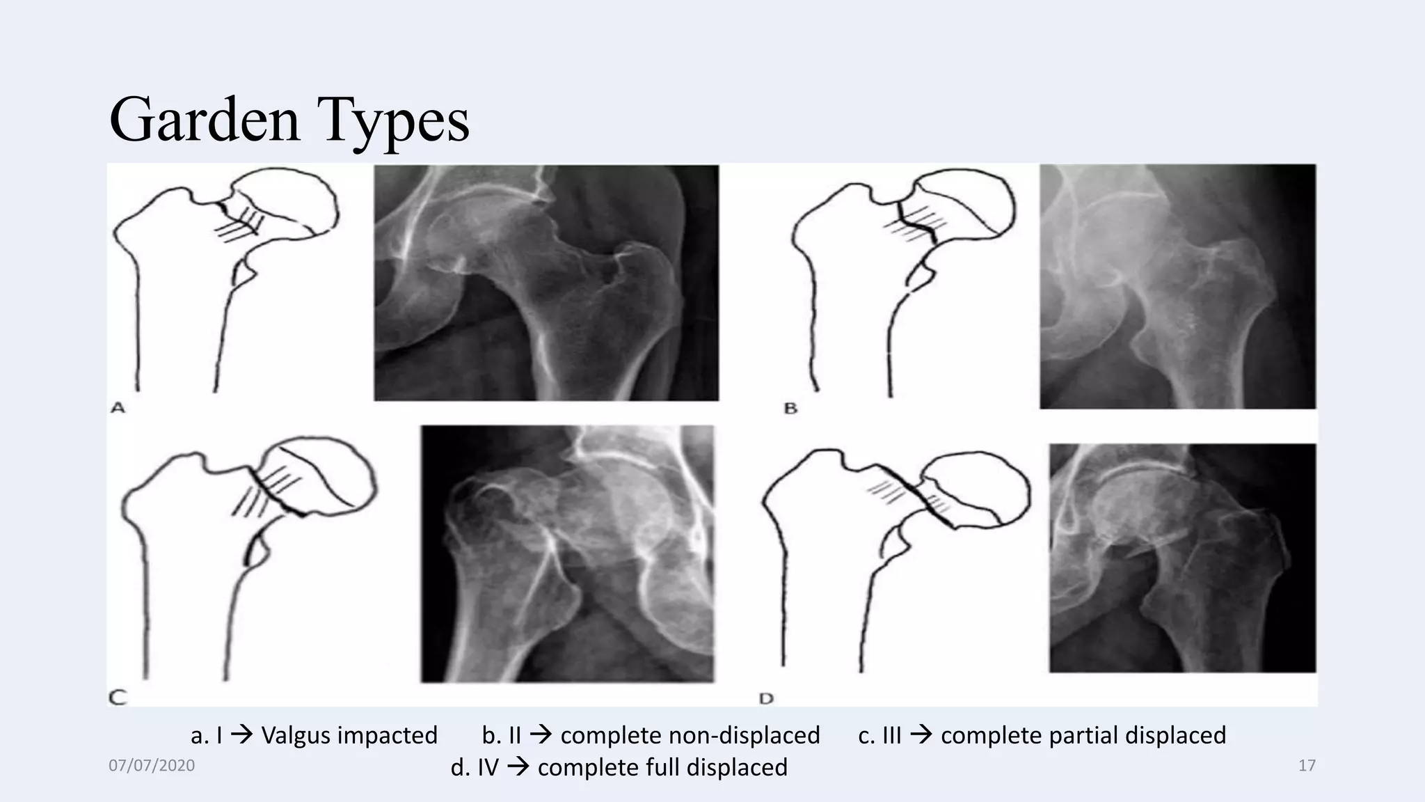 A case of fracture neck of femur | PPTX