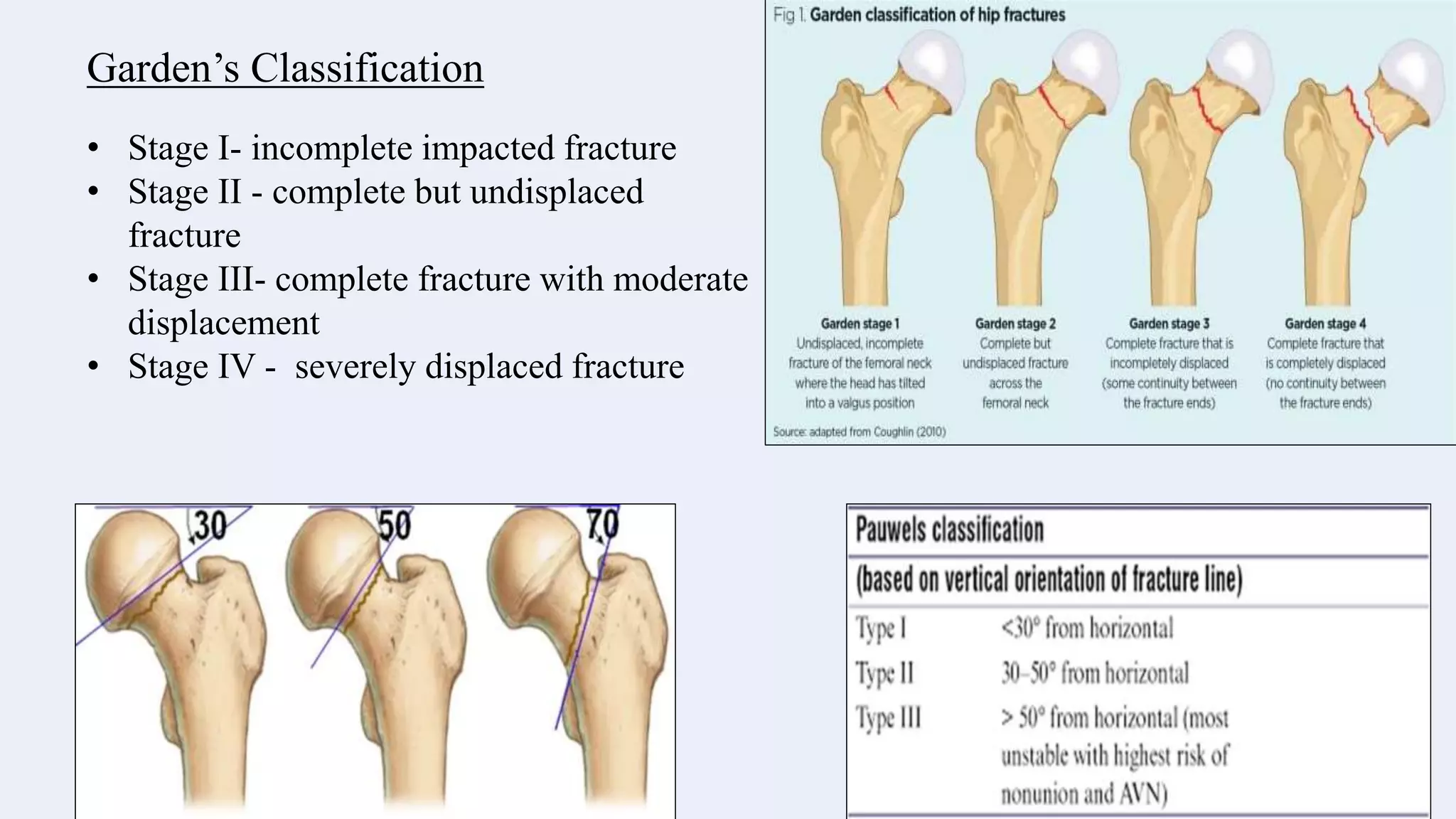A case of fracture neck of femur | PPTX