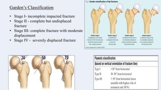 A case of fracture neck of femur | PPTX