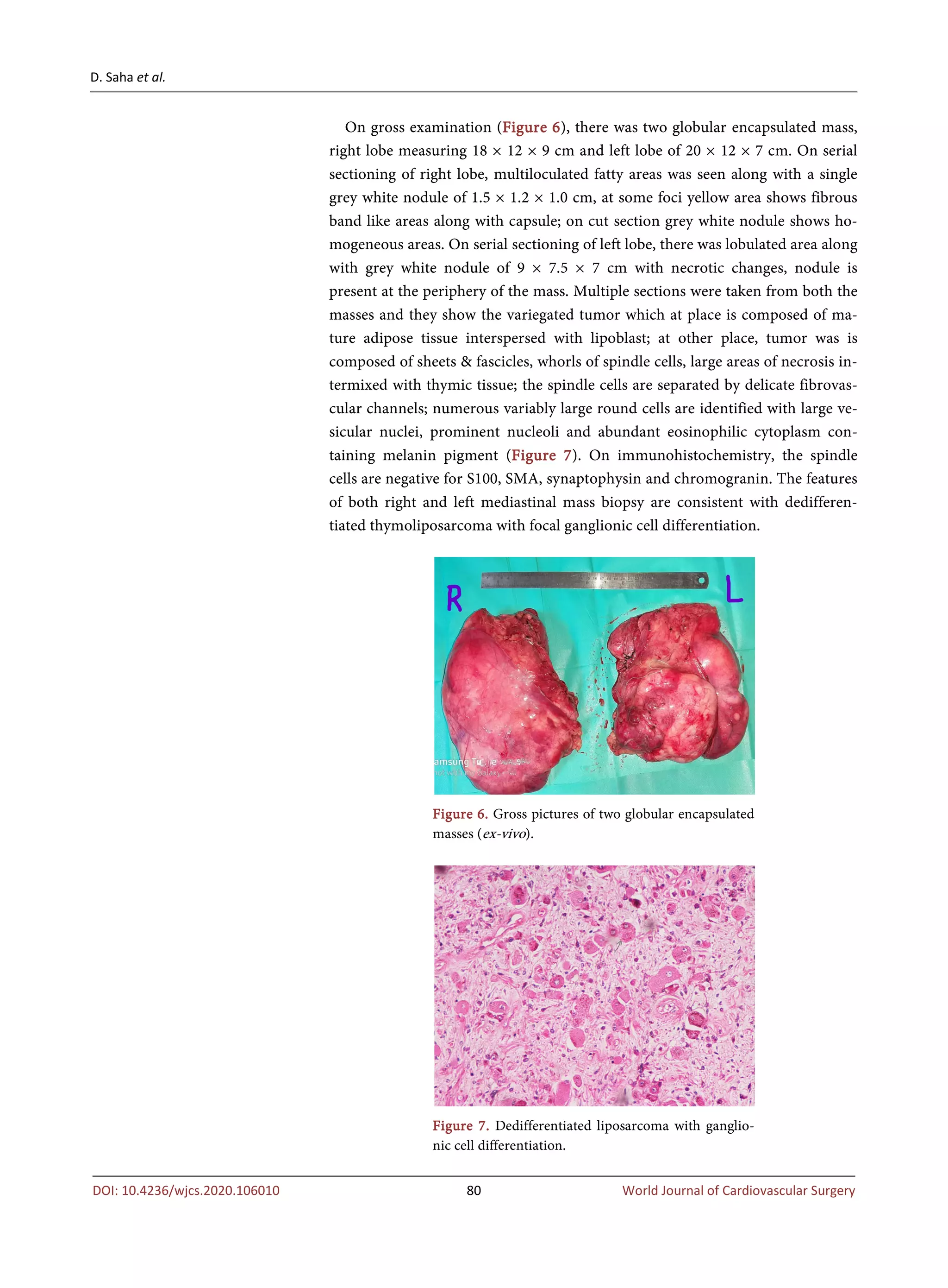 A case of giant mediastinal liposarcoma of thymic origin a rare ...