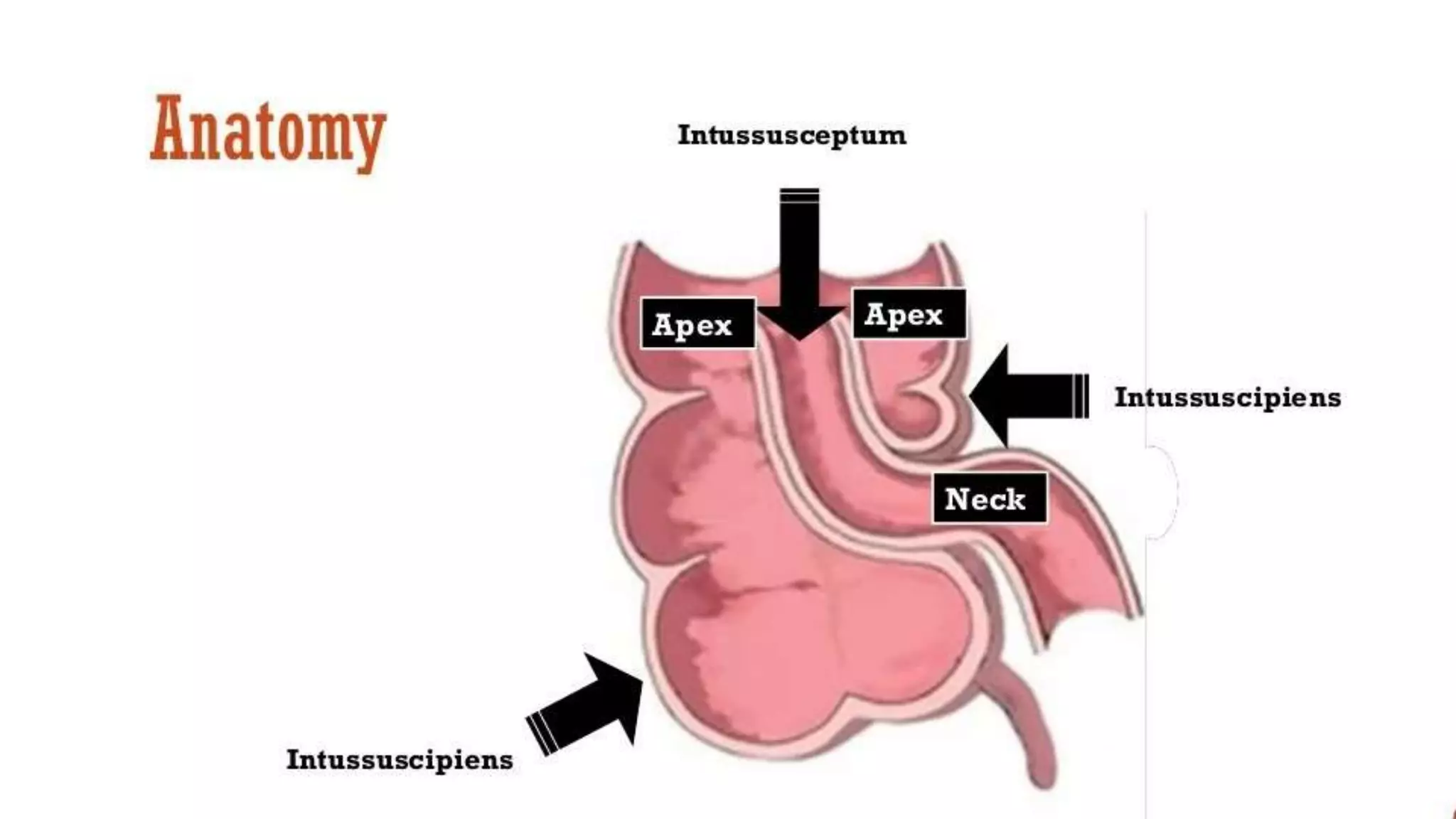 A case of intussusception with peutz jeghers syndrome.pptx