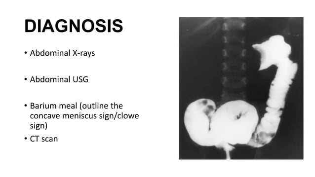 A case of intussusception with peutz jeghers syndrome.pptx