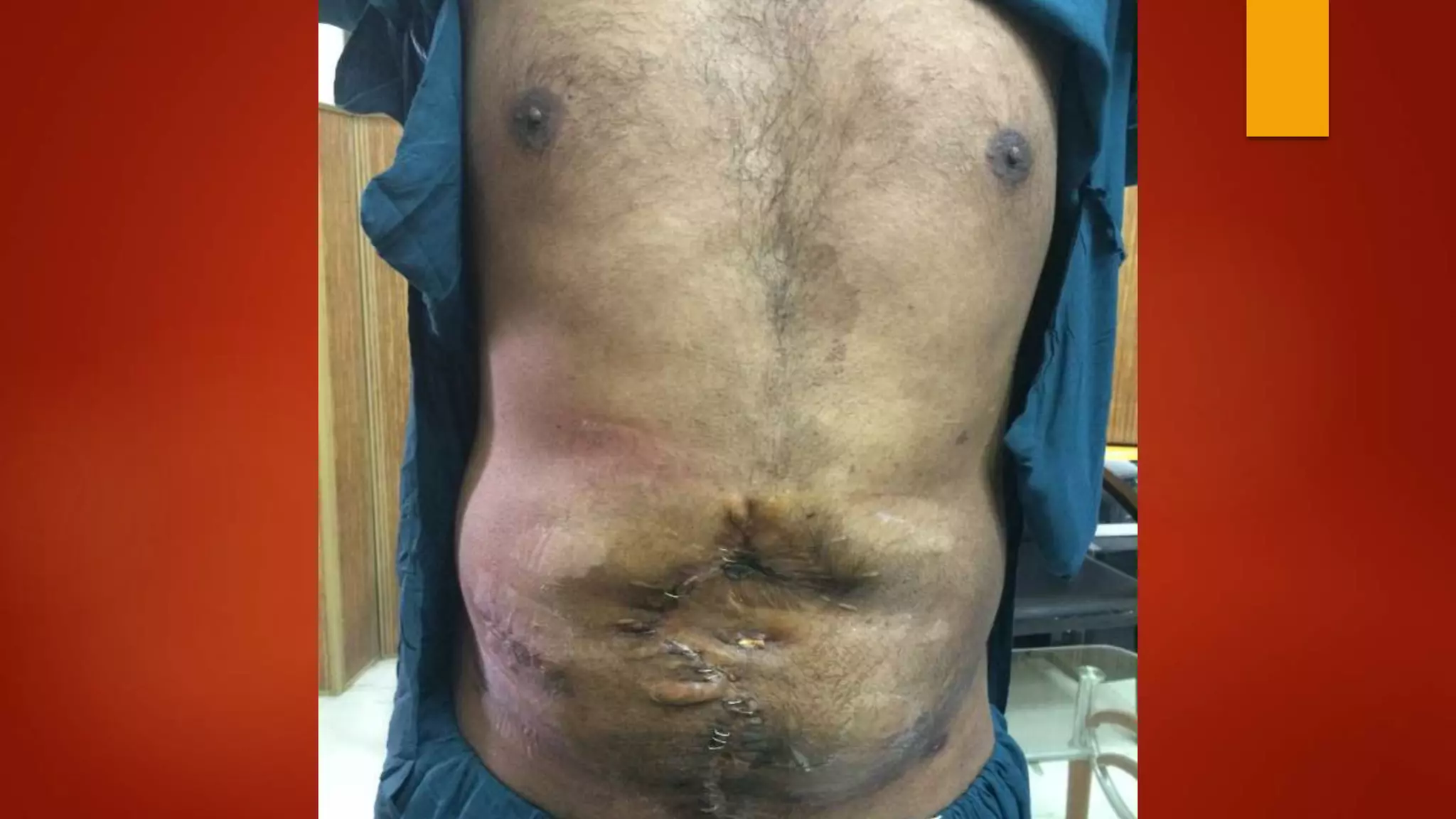 A Case Of Large Recurrent Ventral Hernia Ppt Free Download