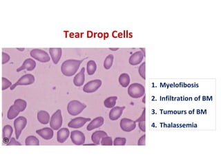 Primary Myelofibrosis Peripheral Smear