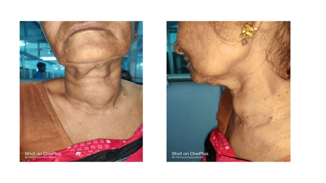 A CASE OF MULTINODULAR GOITRE,clinical presentation and management.pptx