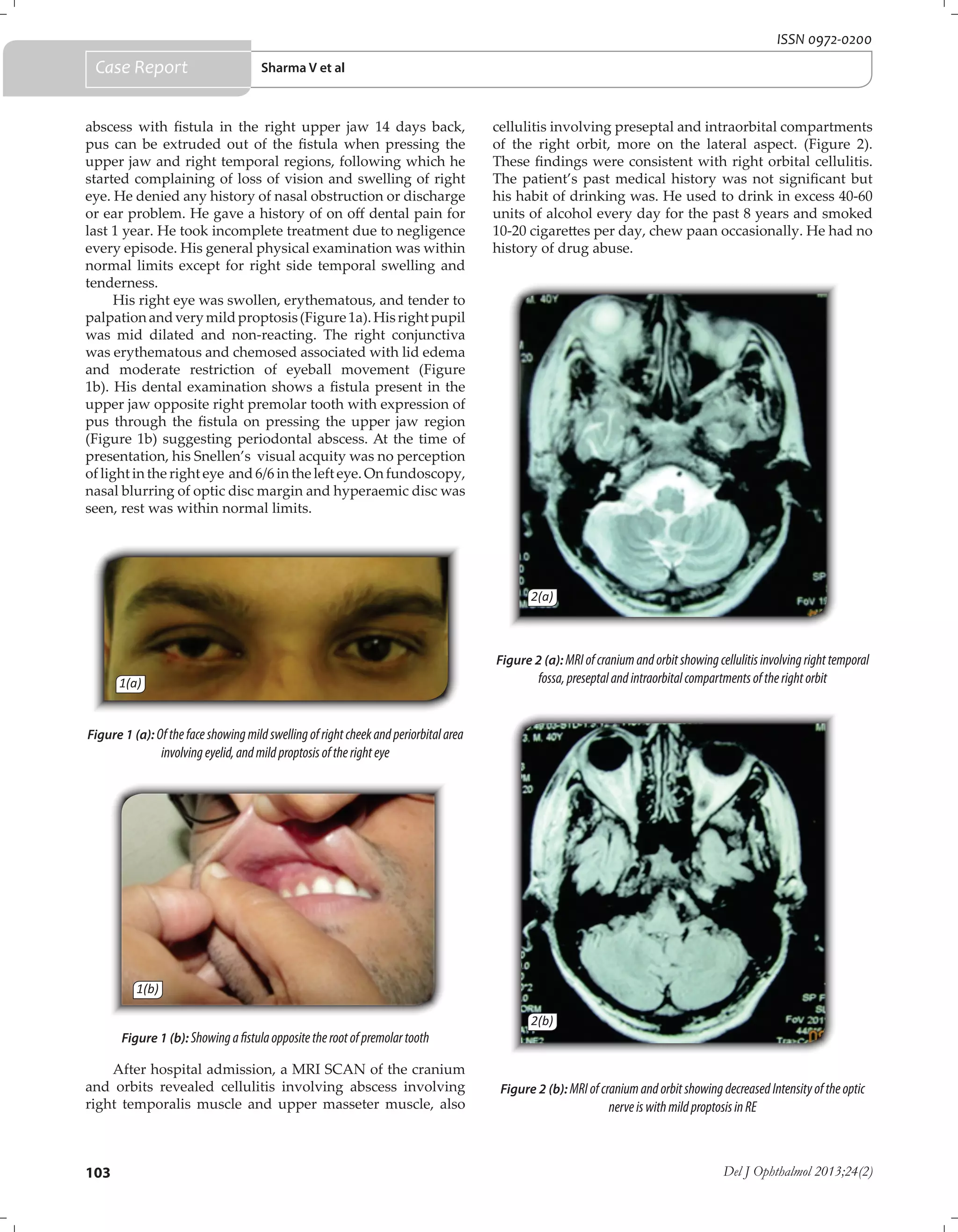 A case of odontogenic orbital cellulitis causing blindness in young ...