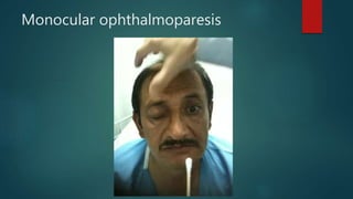 A case of painful ophthalmoplegia | PPTX