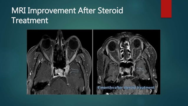A case of painful ophthalmoplegia | PPTX