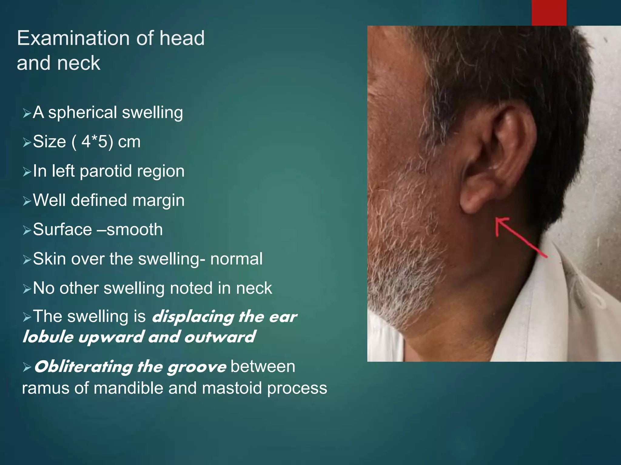A case of parotid tumor | PPTX