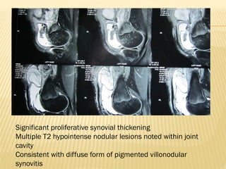 A case of Pigmented Villonodular Synovitis.pptx