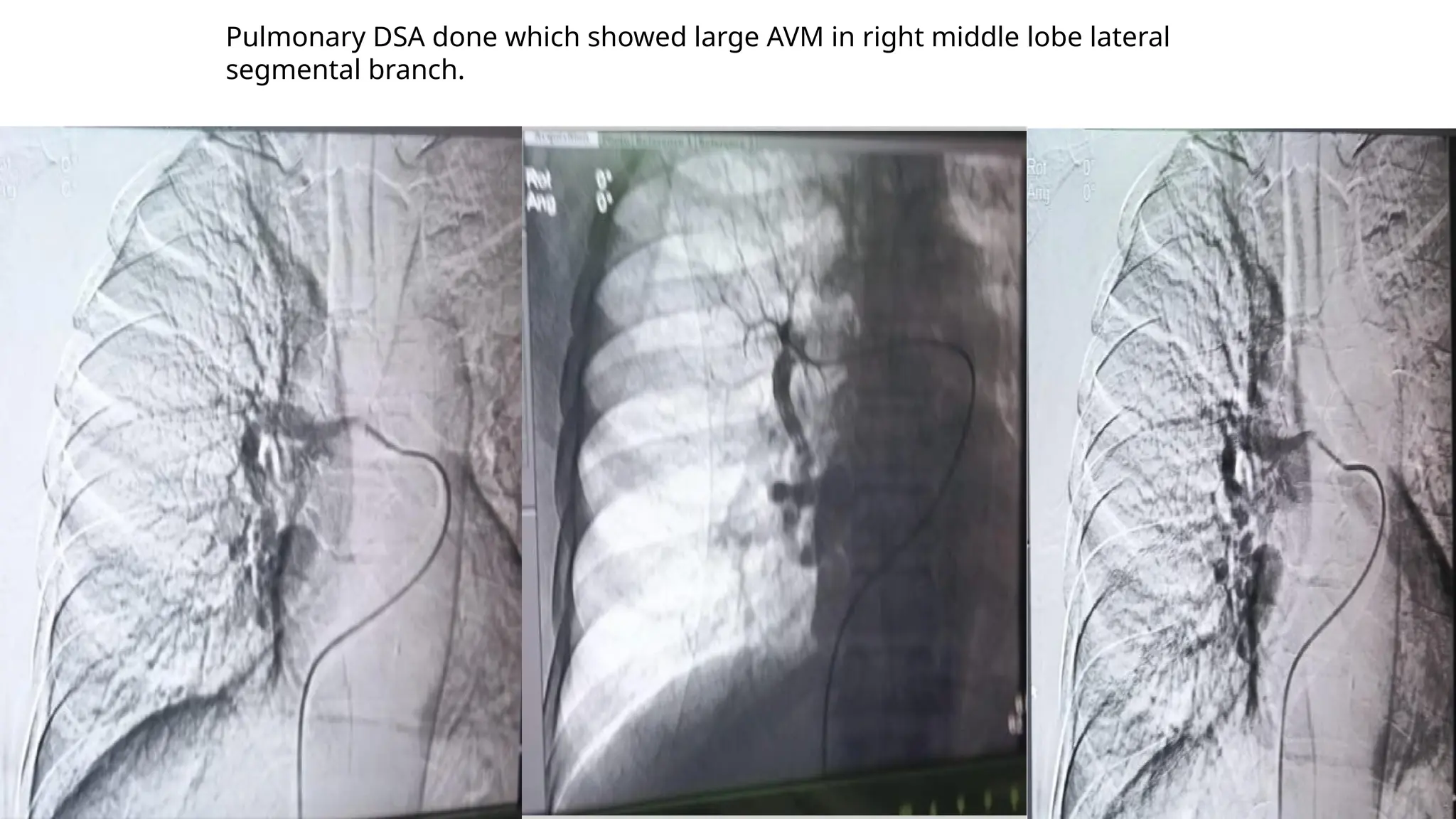 A case of pulmonary AV malformation.pptx