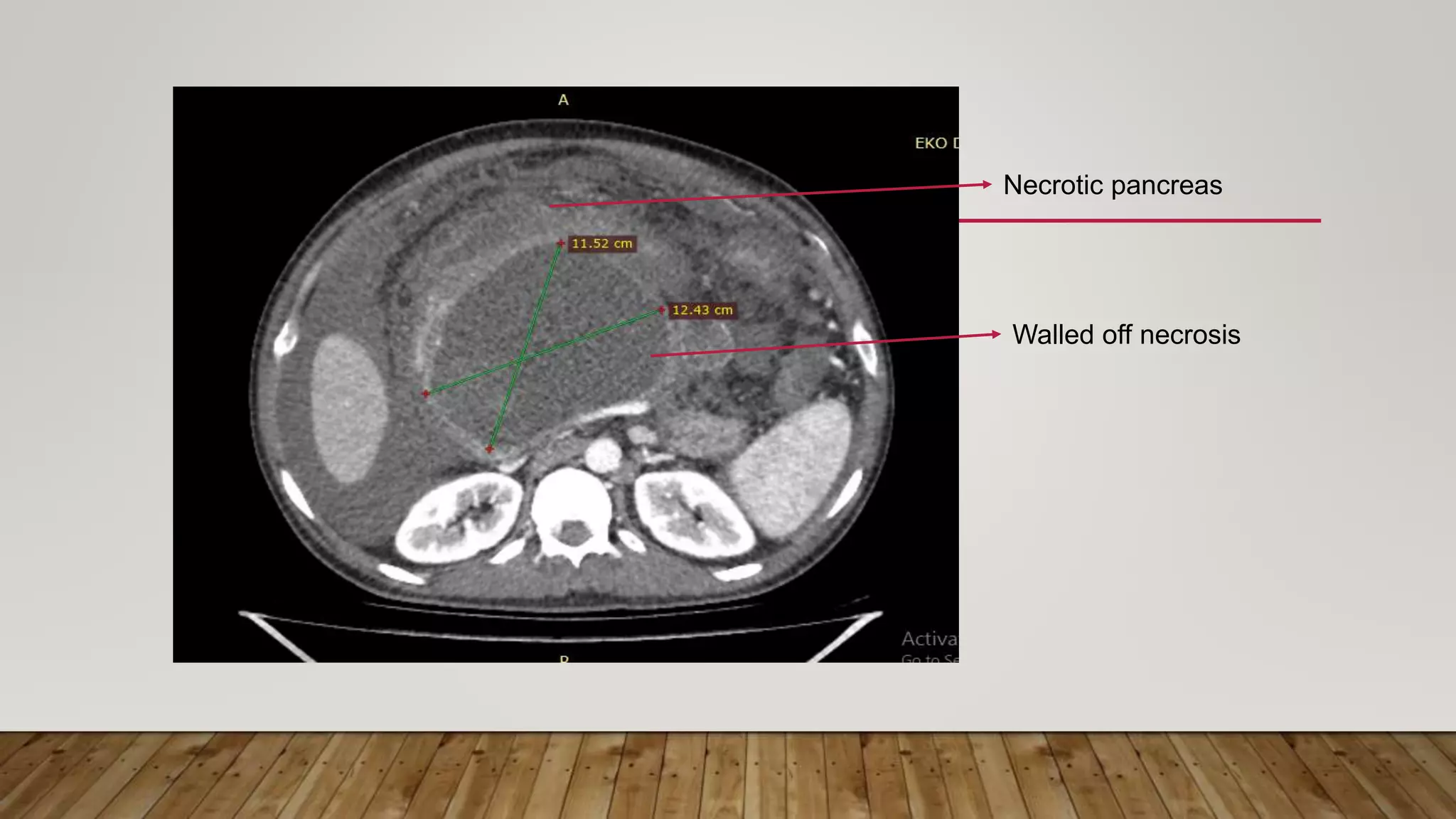 A case of recurrent acute pancreatitis with walled off necrosis ...