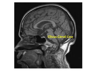 A Case Of Short Neck | PPTX