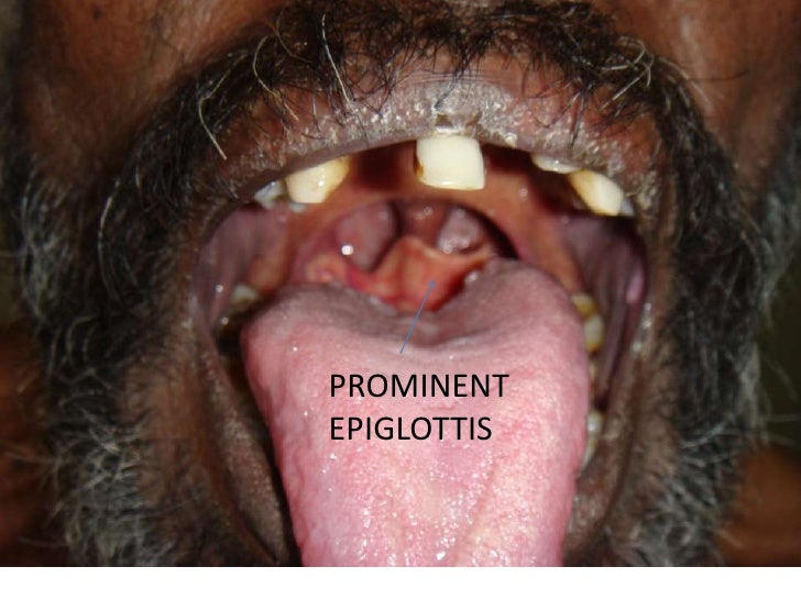 A Case Of Short Neck