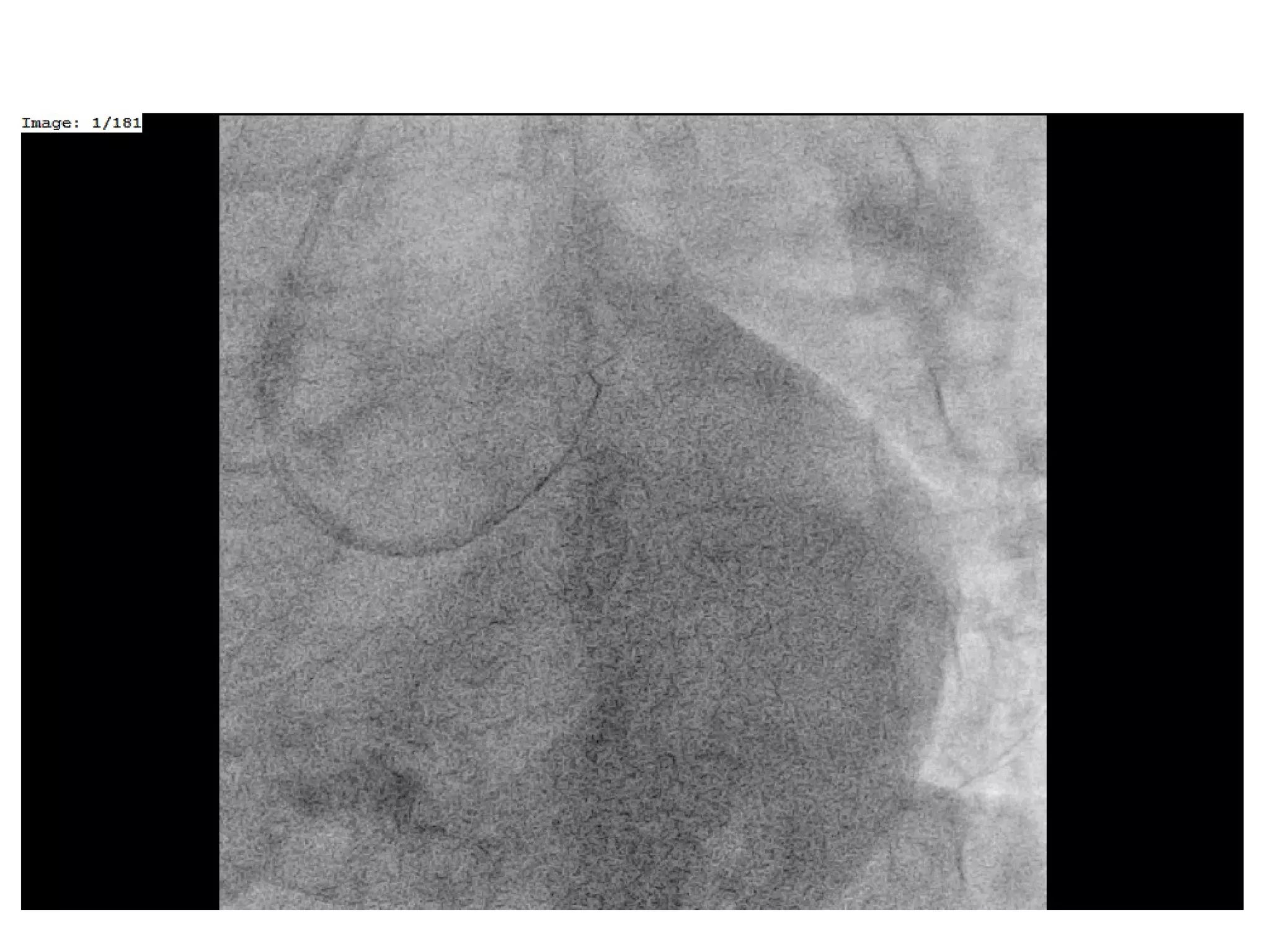 A case of typical stemi in indian scenario | PPT