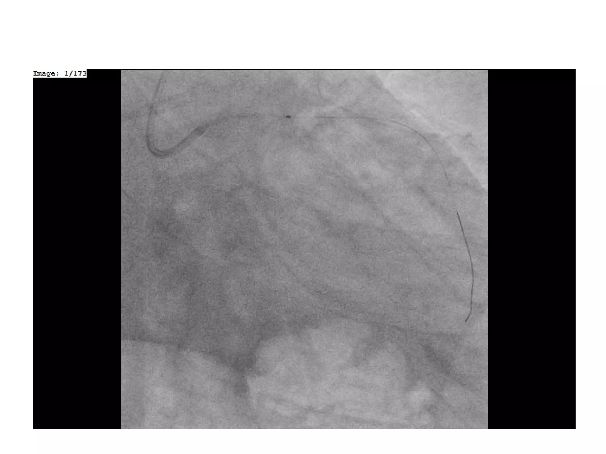 A case of typical stemi in indian scenario | PPT