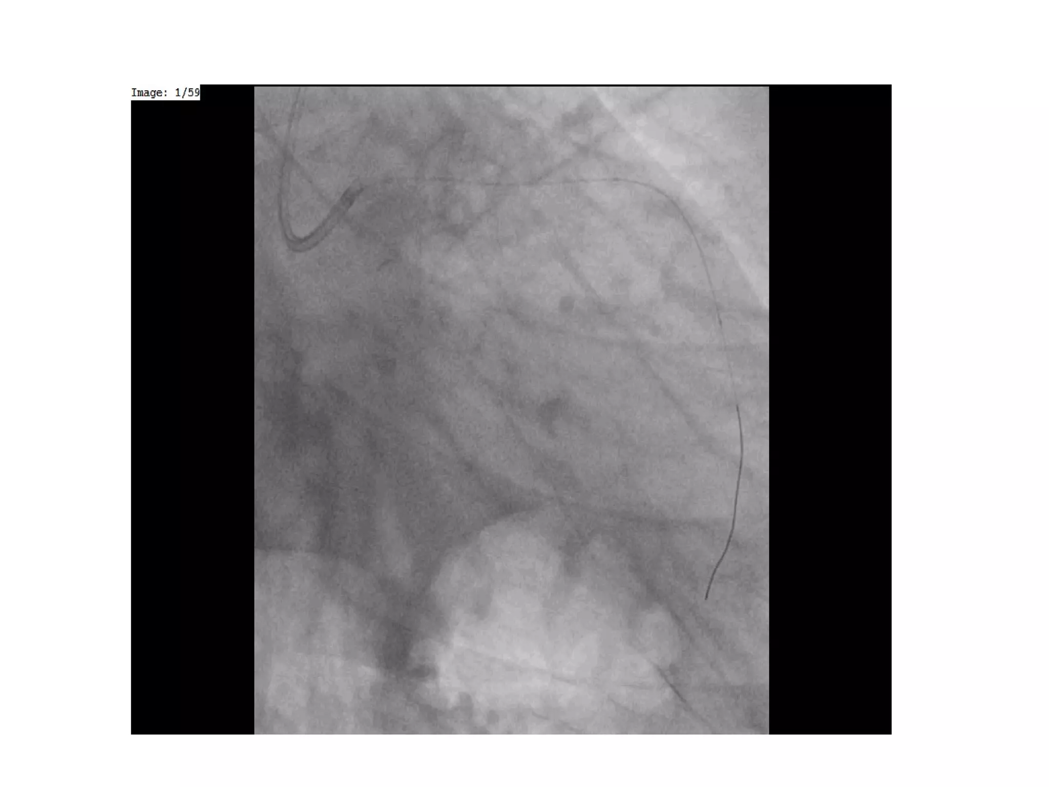 A case of typical stemi in indian scenario | PPT