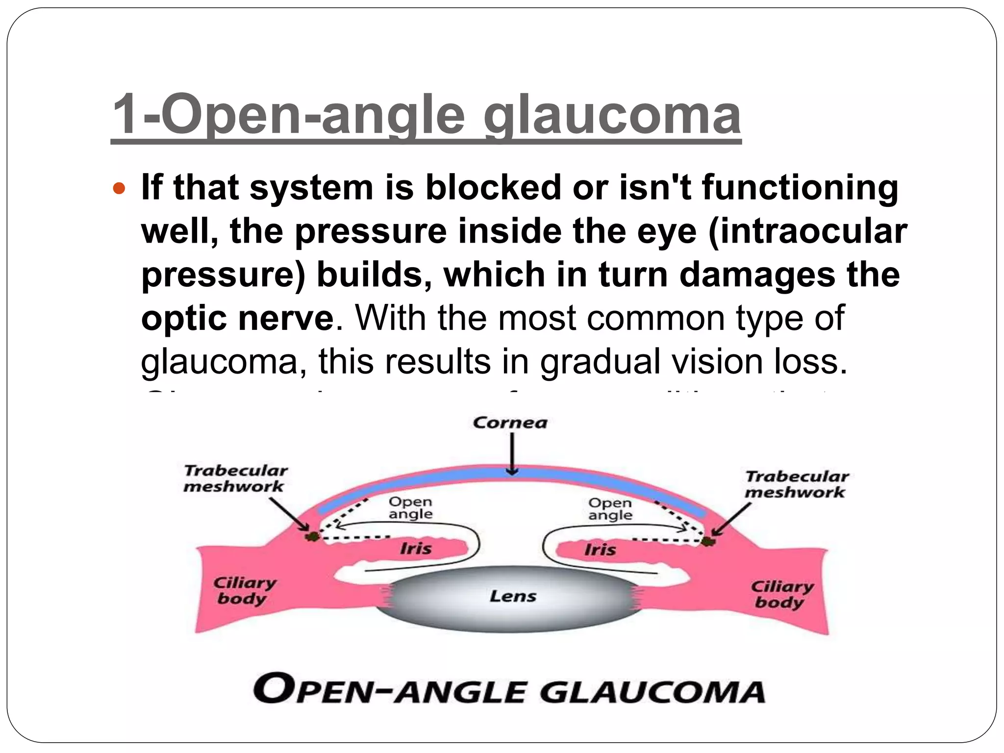 A case presentation on GLAUCOMA..pptx