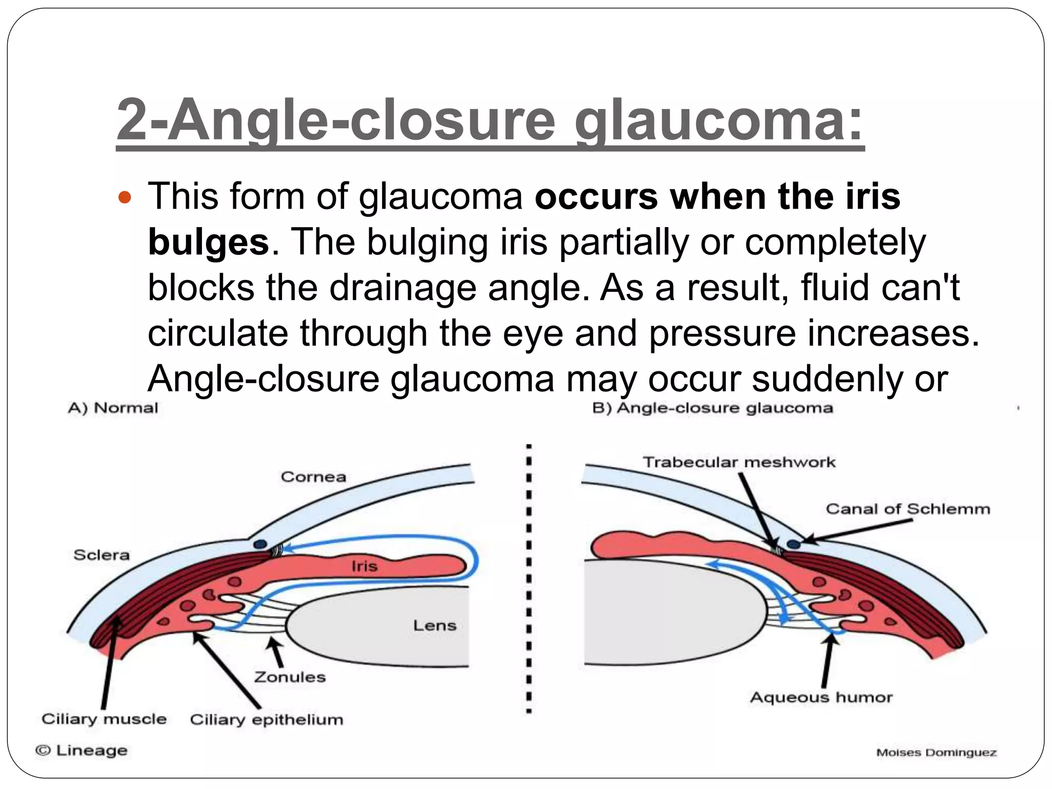 A case presentation on GLAUCOMA..pptx