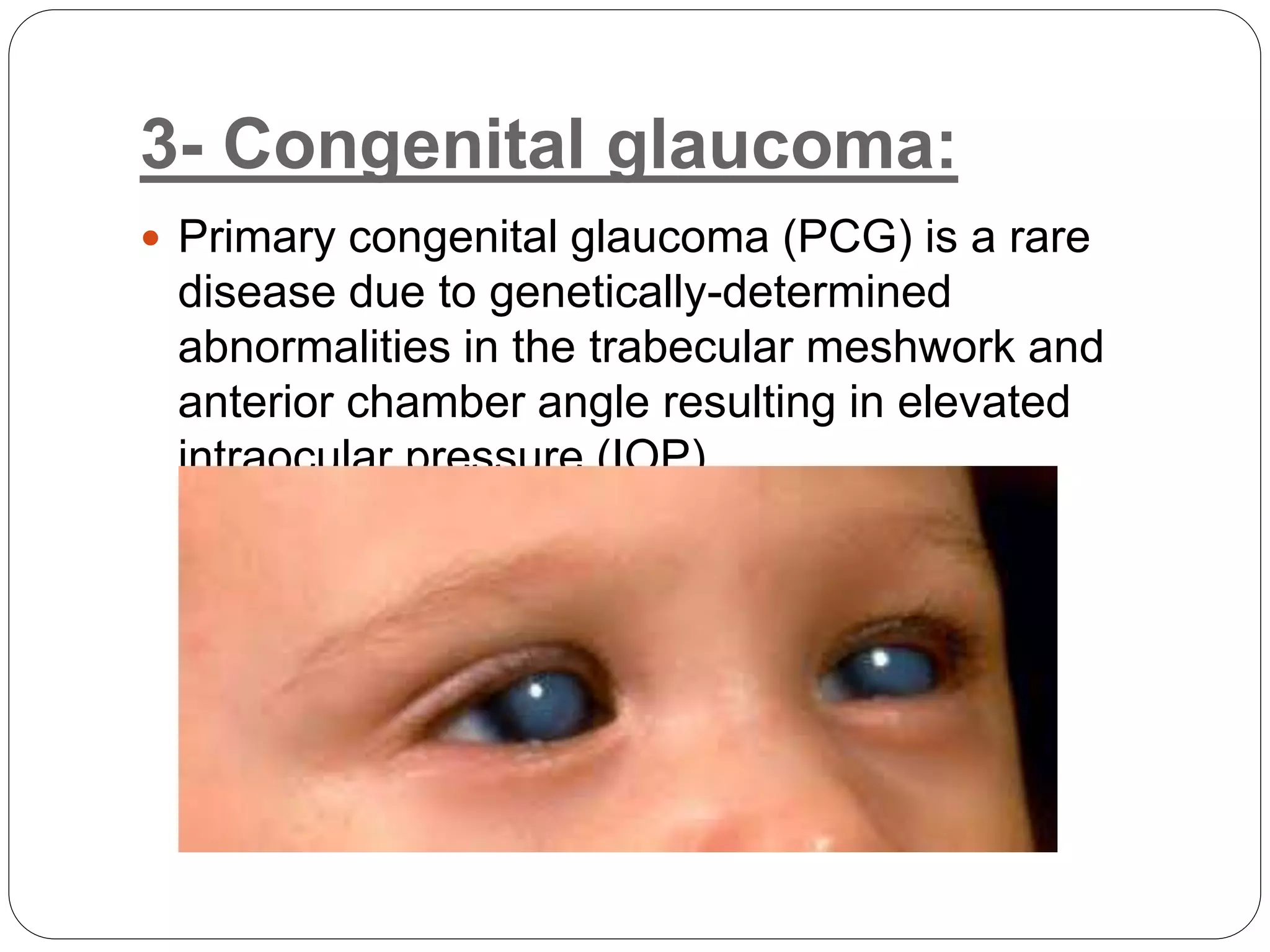 A case presentation on GLAUCOMA..pptx