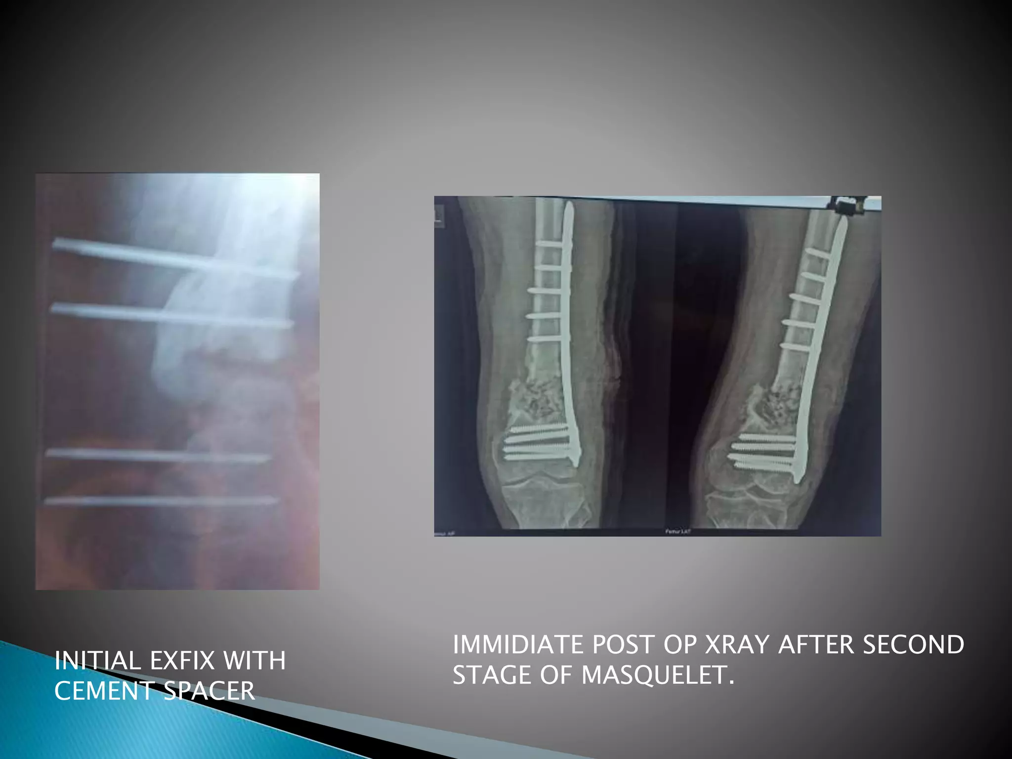 A case presentation on infected non union | PPTX