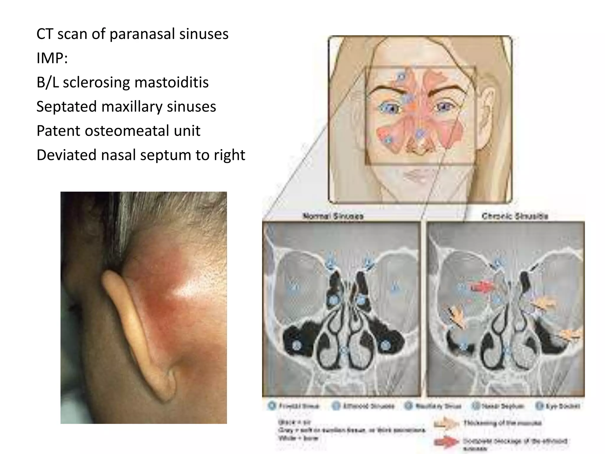 A case study on cervical spondylitis | PPTX