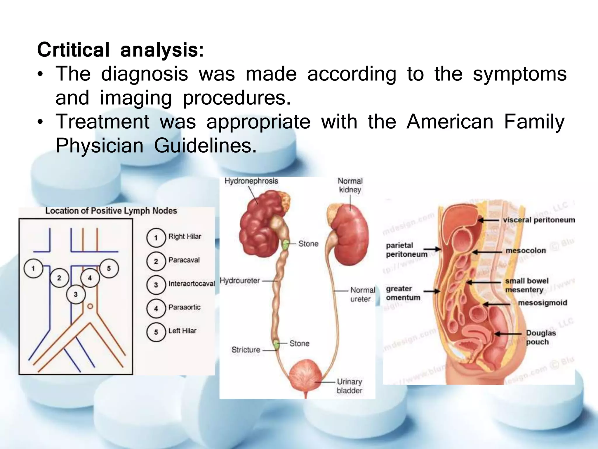 A case study on emphysematous pyelonephritis | PPT