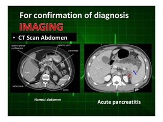 A case study on acute pancreatitis | PPTX