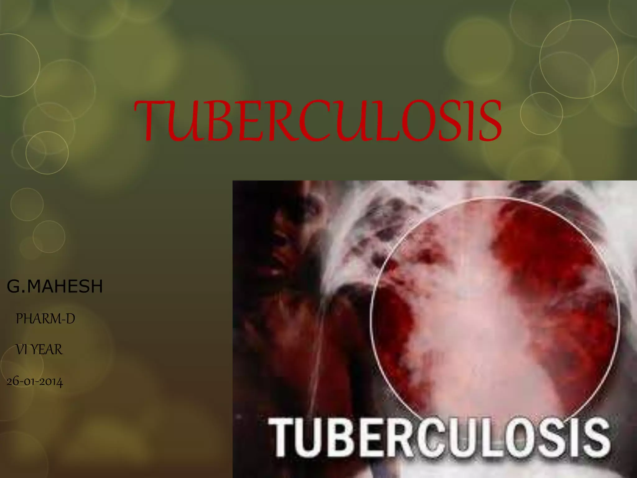 A case study on tuberculosis | PPTX