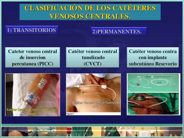 ACCESO VENOSO CENTRAL Catreter venoso central