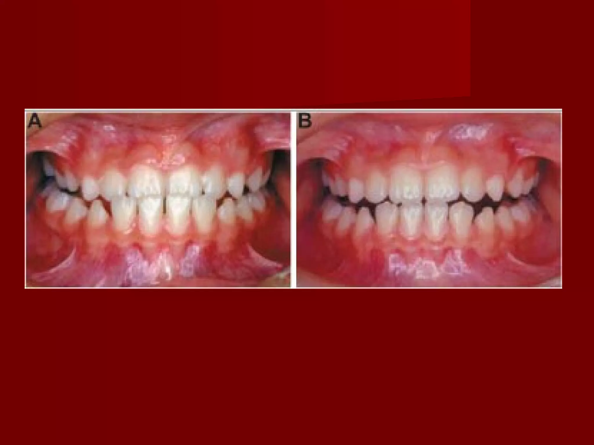 Anterior Crossbite | PPT