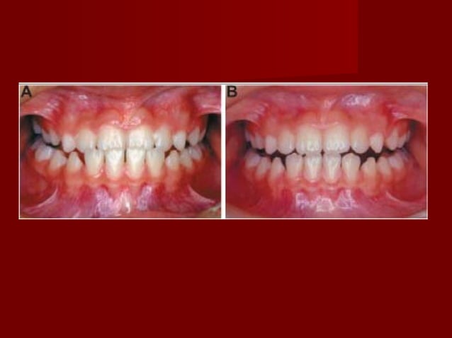 Anterior Crossbite | PPT | Dental Health | Diseases and Conditions