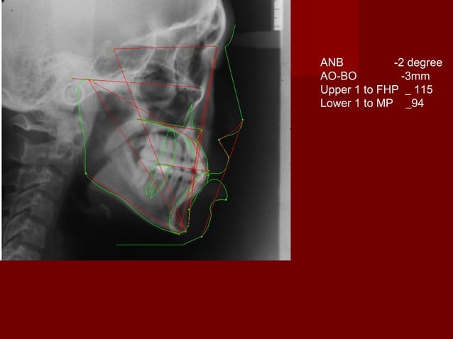 Anterior Crossbite | PPT | Dental Health | Diseases and Conditions