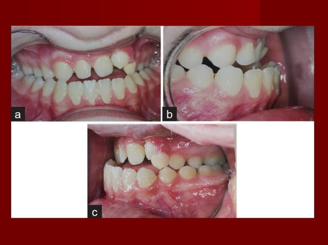 Anterior Crossbite | PPT | Dental Health | Diseases and Conditions