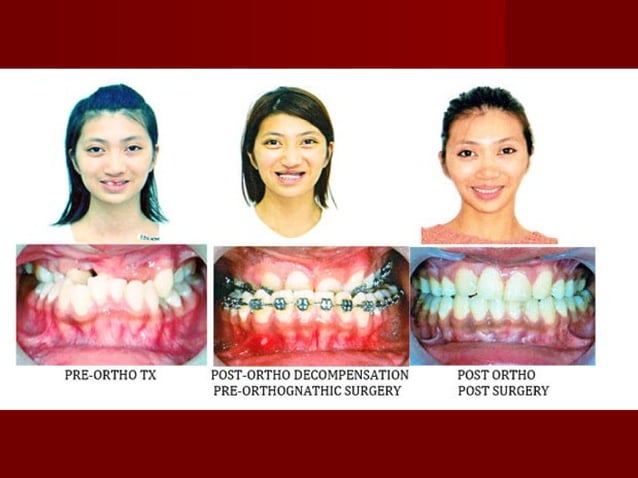 Anterior Crossbite | PPT | Dental Health | Diseases and Conditions