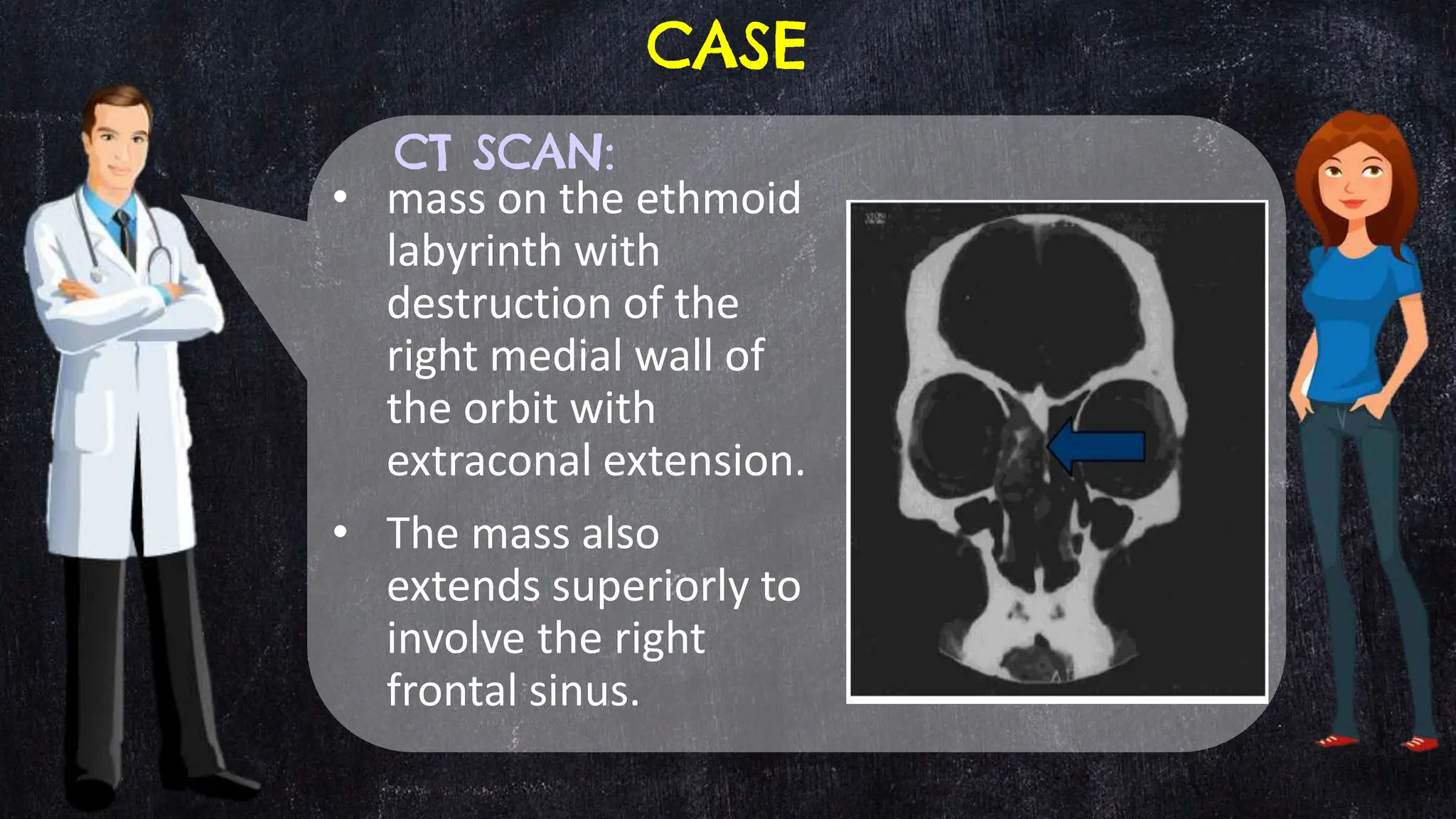 Adenoid Cystic Carcinoma of the Ethmoid Sinus | PPTX