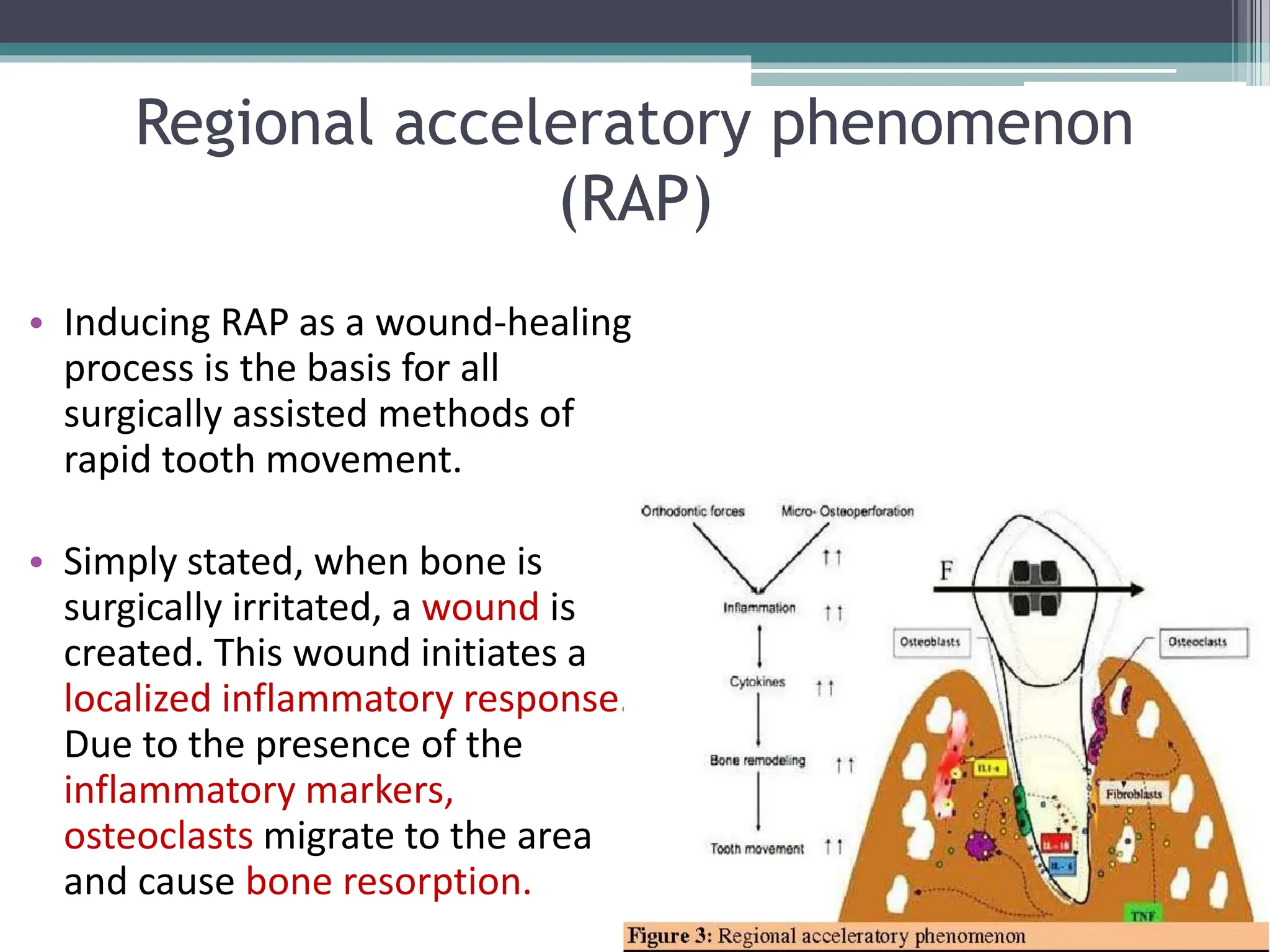 Accelerated Orthodontics, in light of current evidence | PPTX