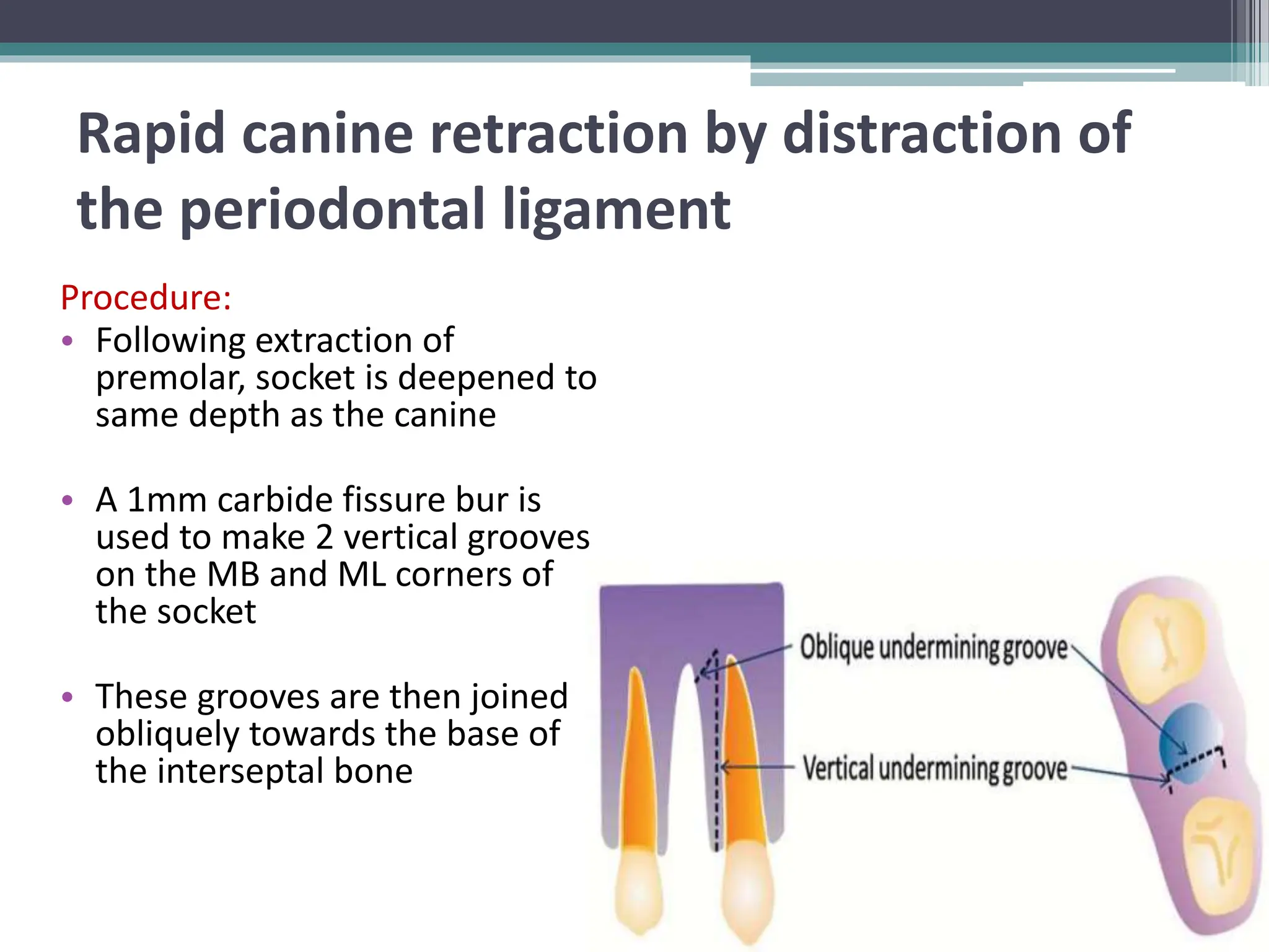 Accelerated Orthodontics, in light of current evidence | PPTX