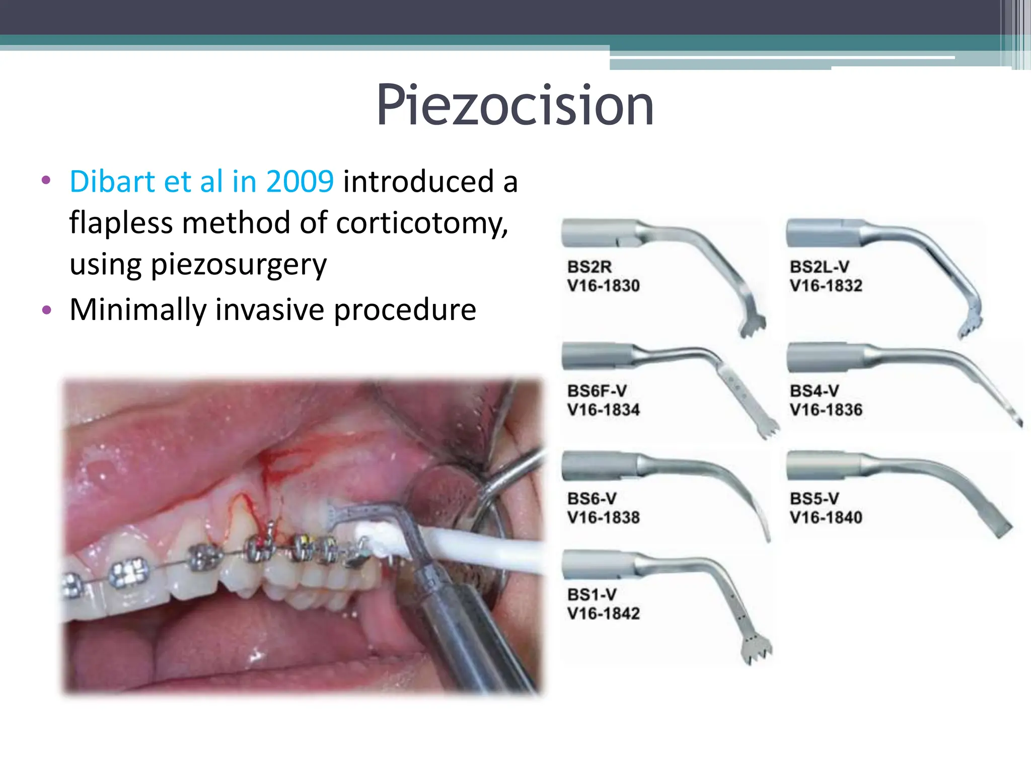 Accelerated Orthodontics, in light of current evidence | PPTX