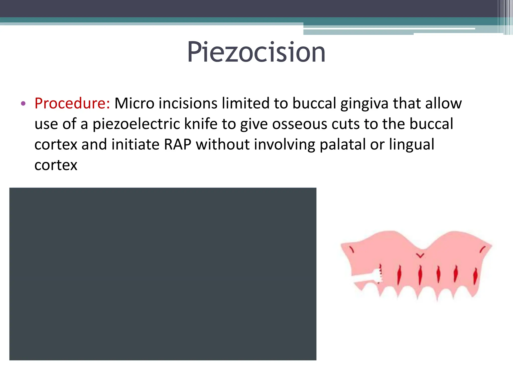 Accelerated Orthodontics, in light of current evidence | PPTX