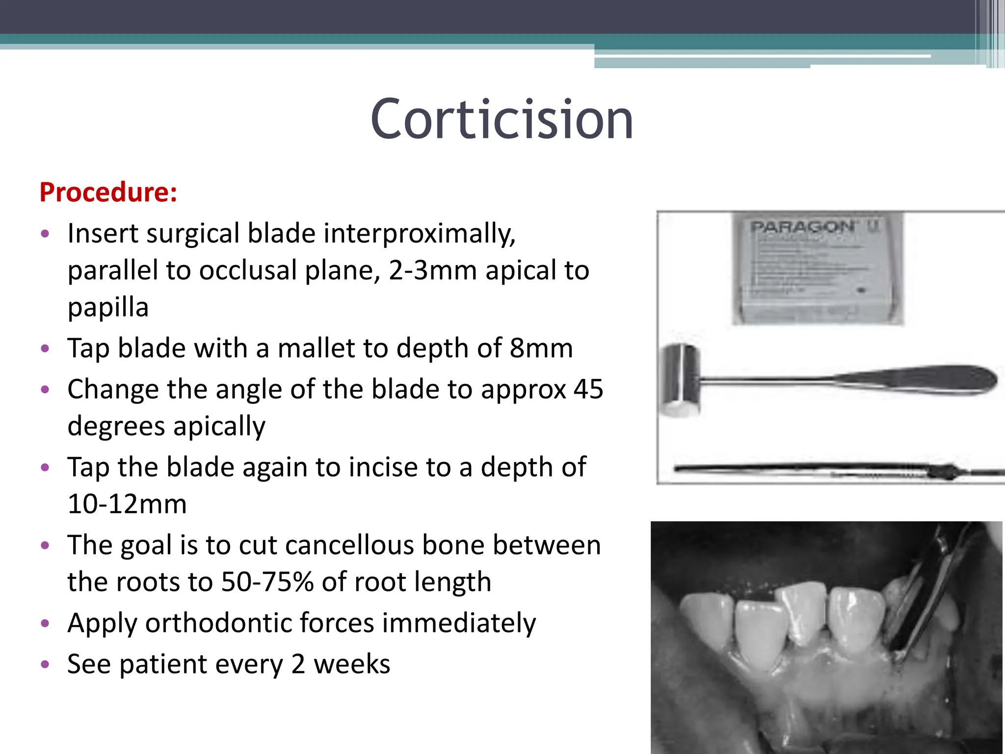 Accelerated Orthodontics, in light of current evidence | PPTX
