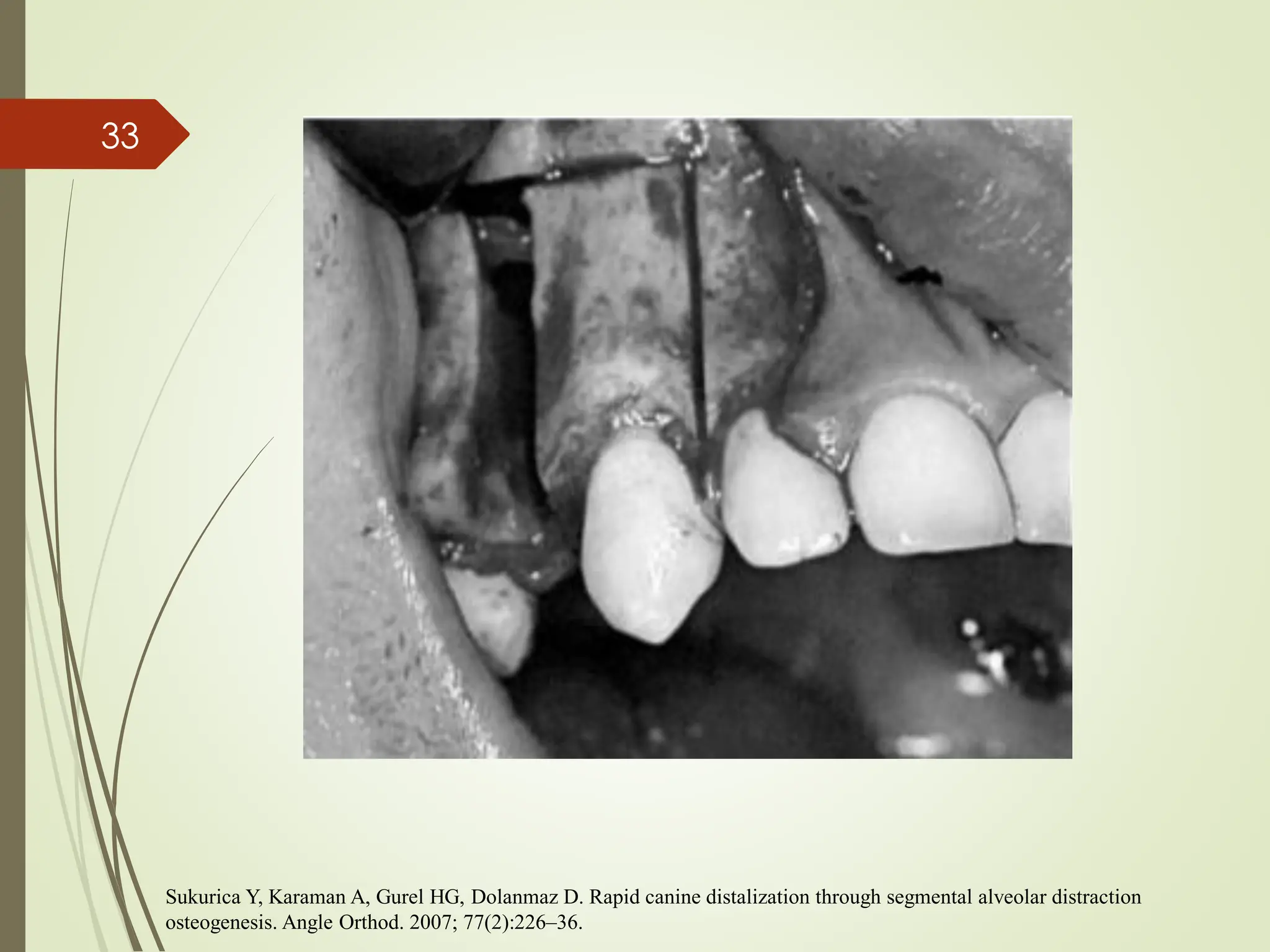 ACCELERATED ORTHODONTICS in orthodontic tooth movemnet | PDF | Bone and Joint Conditions ...