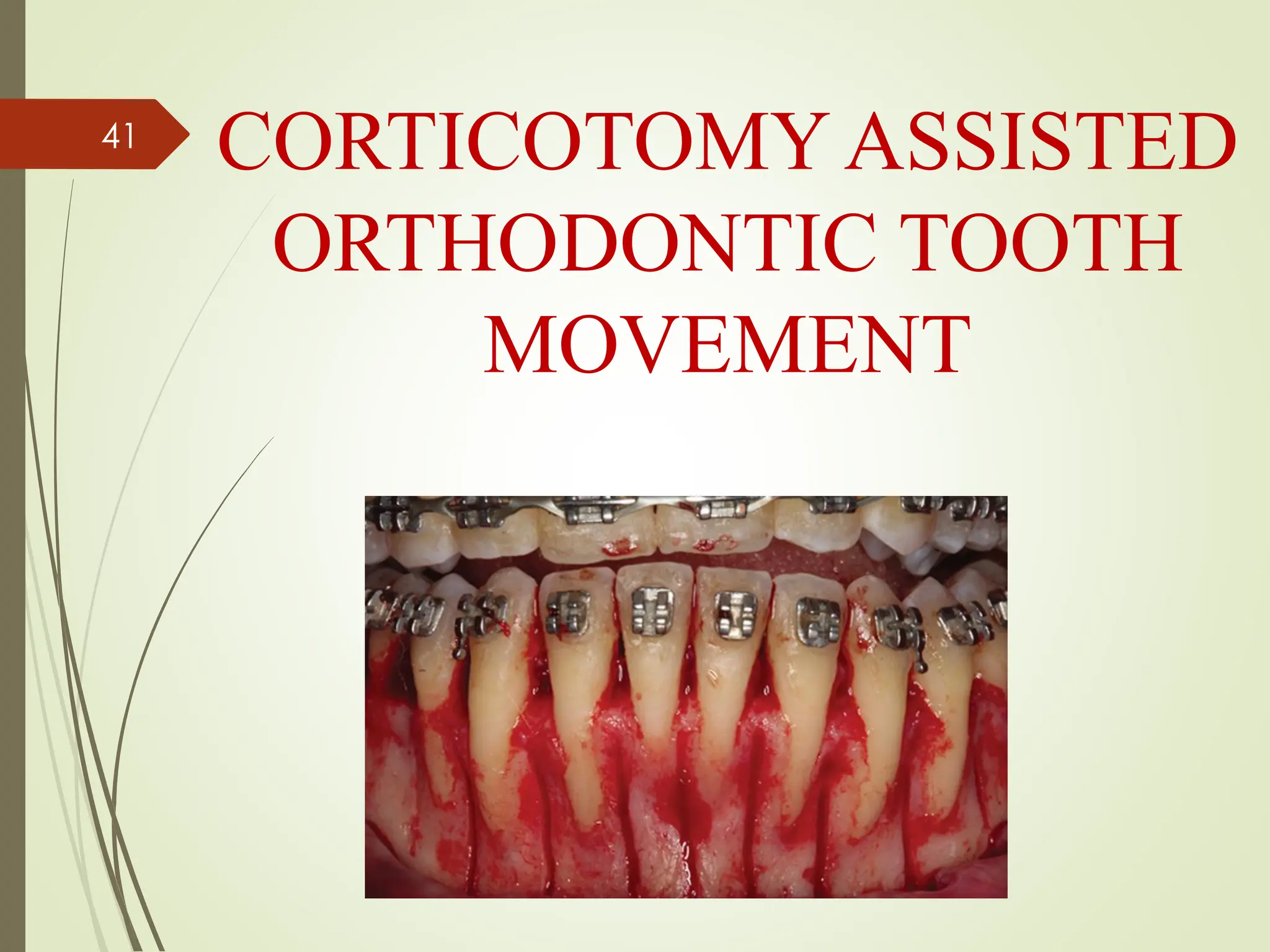 ACCELERATED ORTHODONTICS in orthodontic tooth movemnet | PDF | Bone and Joint Conditions ...