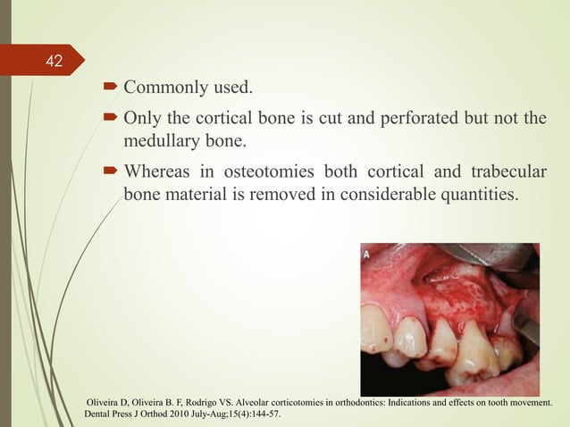 ACCELERATED ORTHODONTICS in orthodontic tooth movemnet | PDF | Bone and Joint Conditions ...