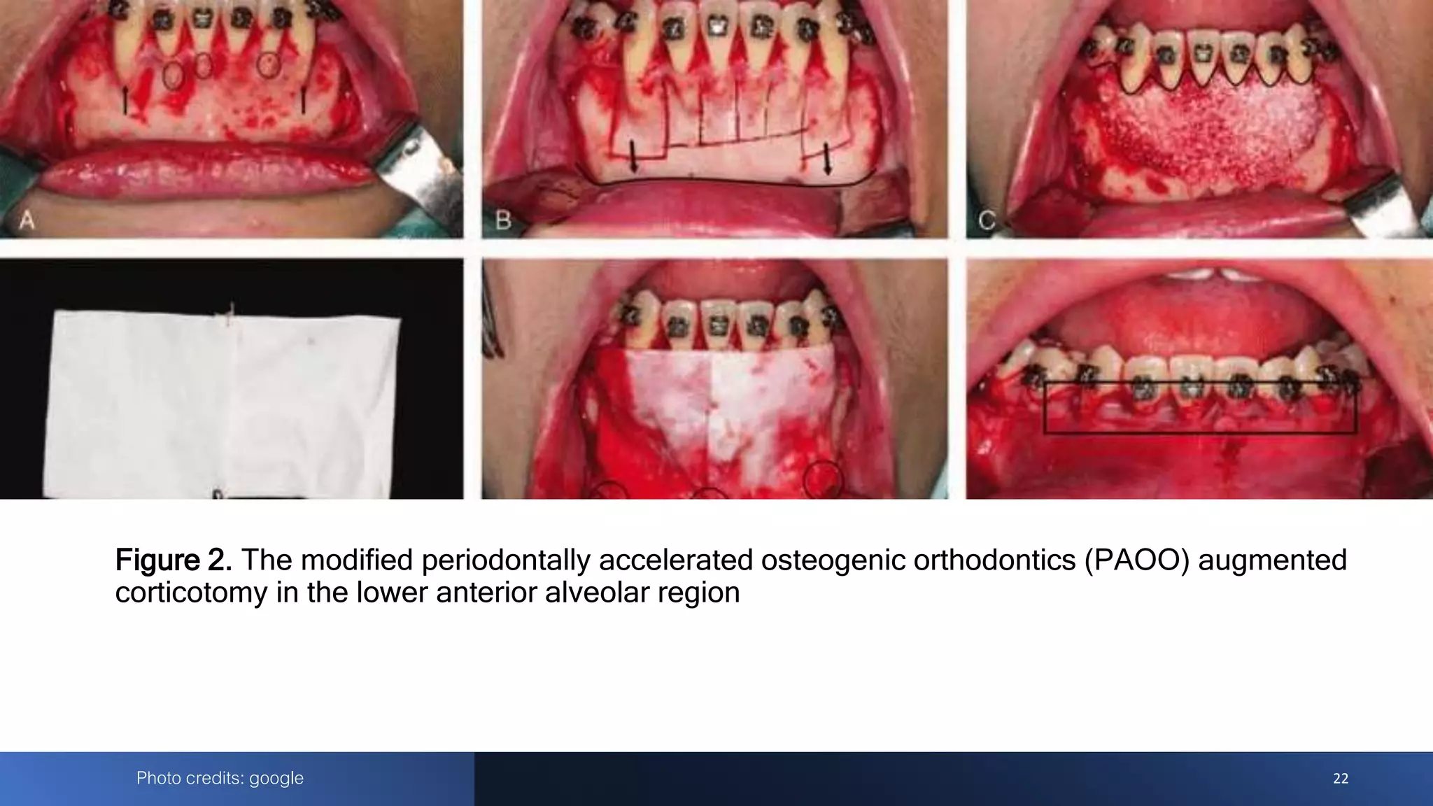 Accelerated orthodontics.pptx