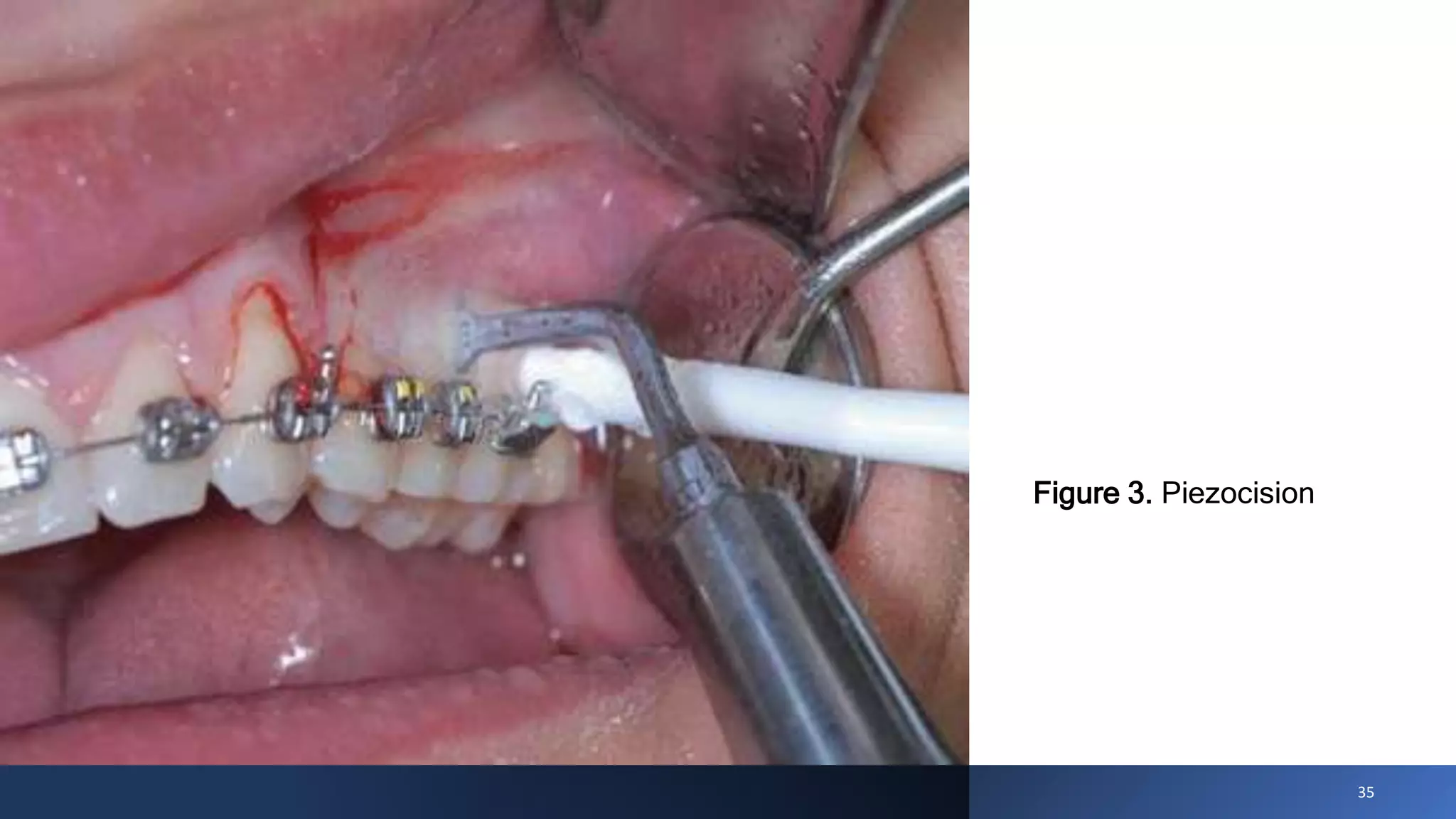Accelerated orthodontics.pptx