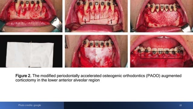 Accelerated orthodontics.pptx | Bone and Joint Conditions | Diseases ...