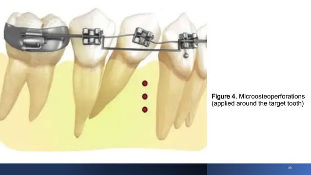 Accelerated orthodontics.pptx | Bone and Joint Conditions | Diseases and Conditions