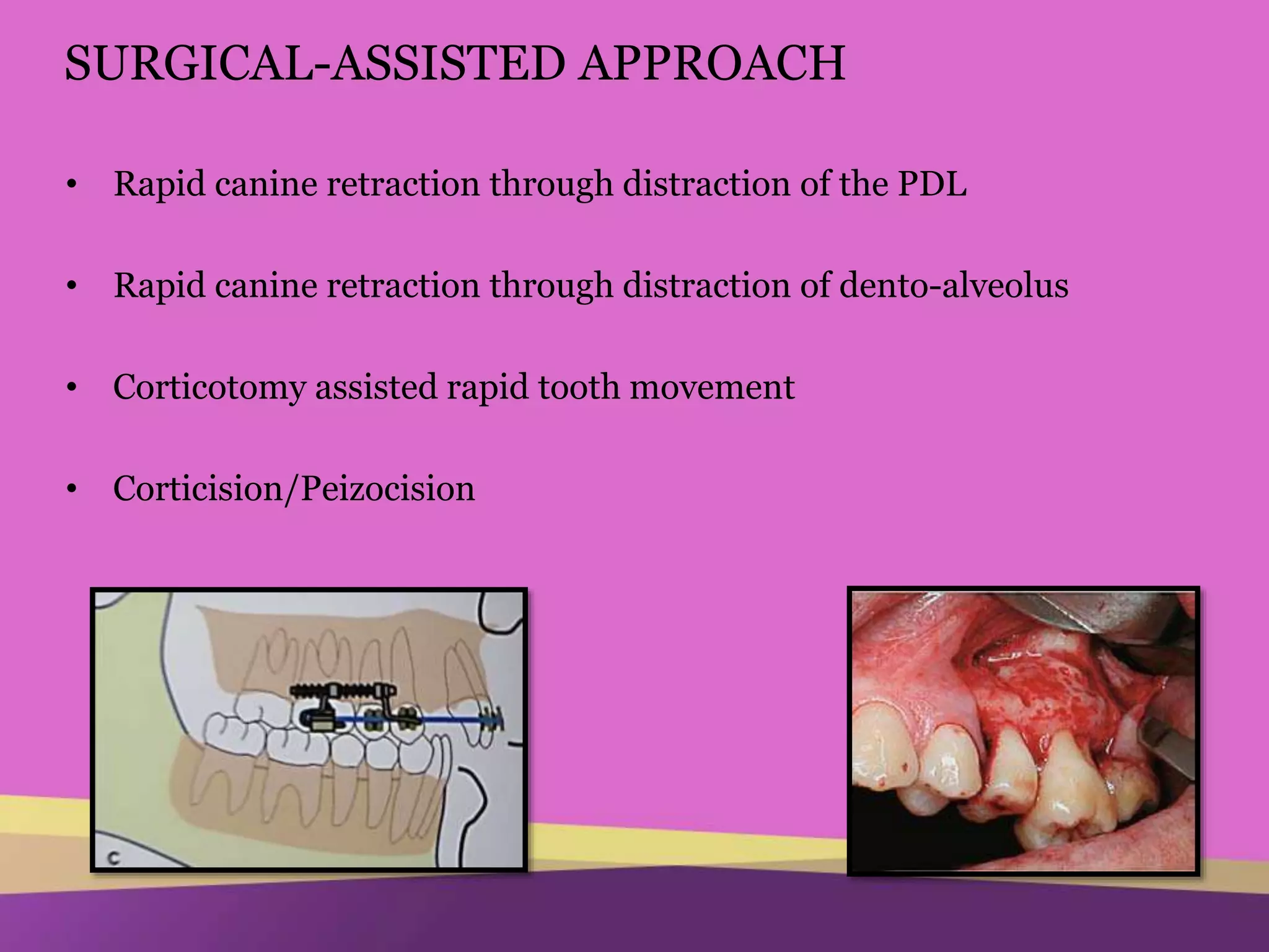 Accelerated orthodontic tooth movement | PPTX